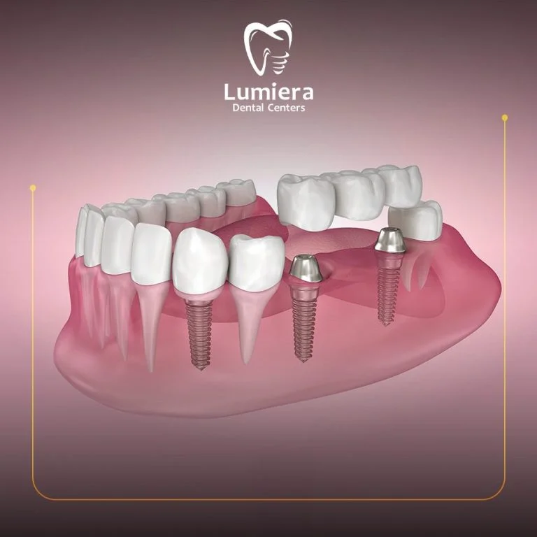 Dental Fixtures - Dr. Noura Radwan